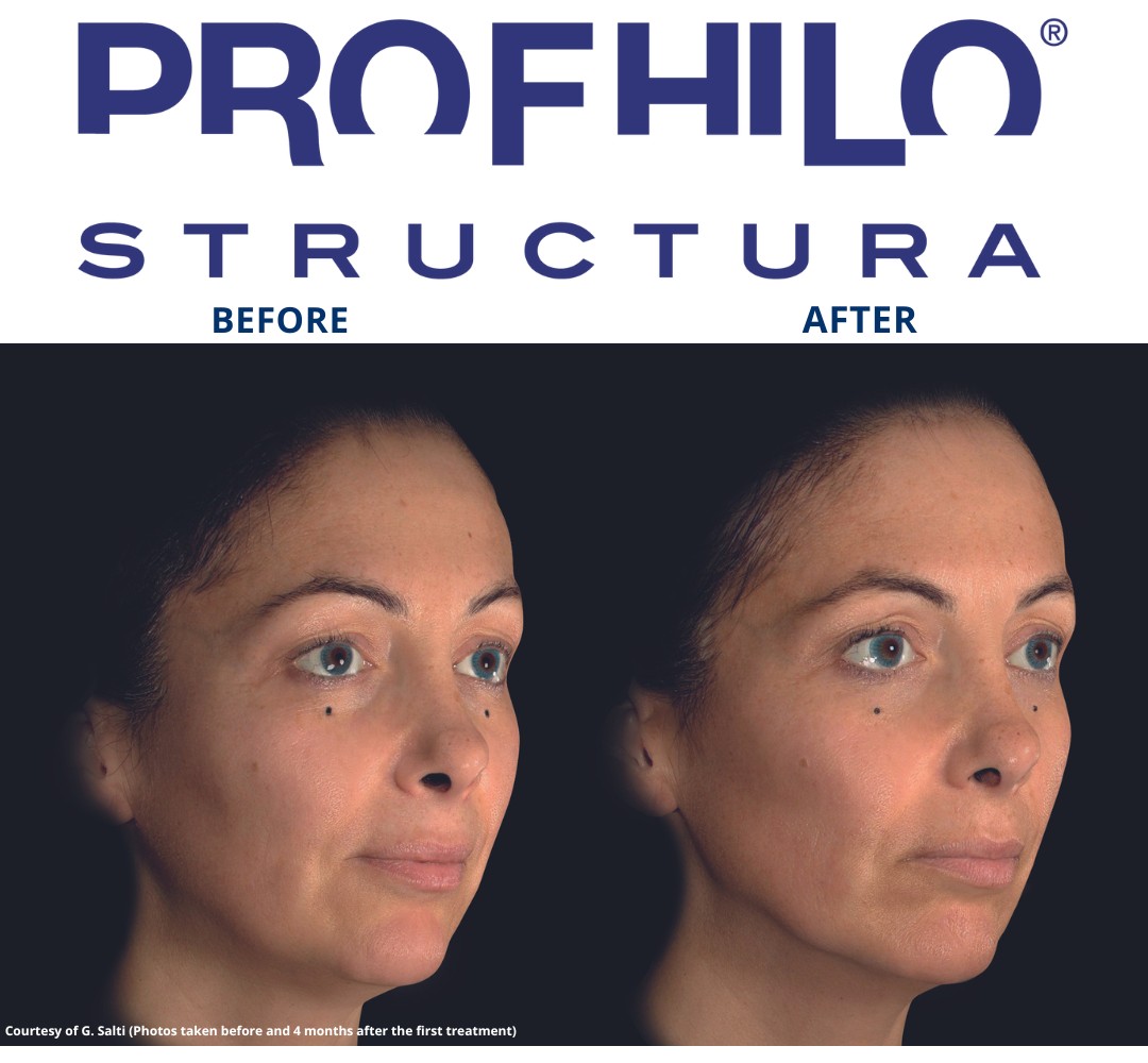 Profhilo Structura - Cindy Knight Clinic